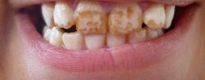 Fluorose dentária - o que é e como previnir - Clinica Soliva
