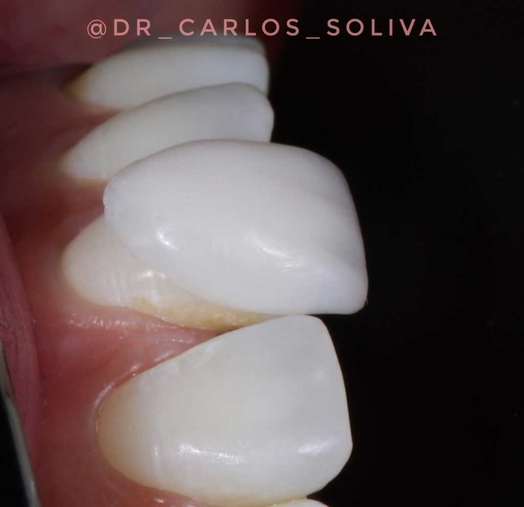 FACETA DE RESINA E PORCELANA - Clinica Soliva